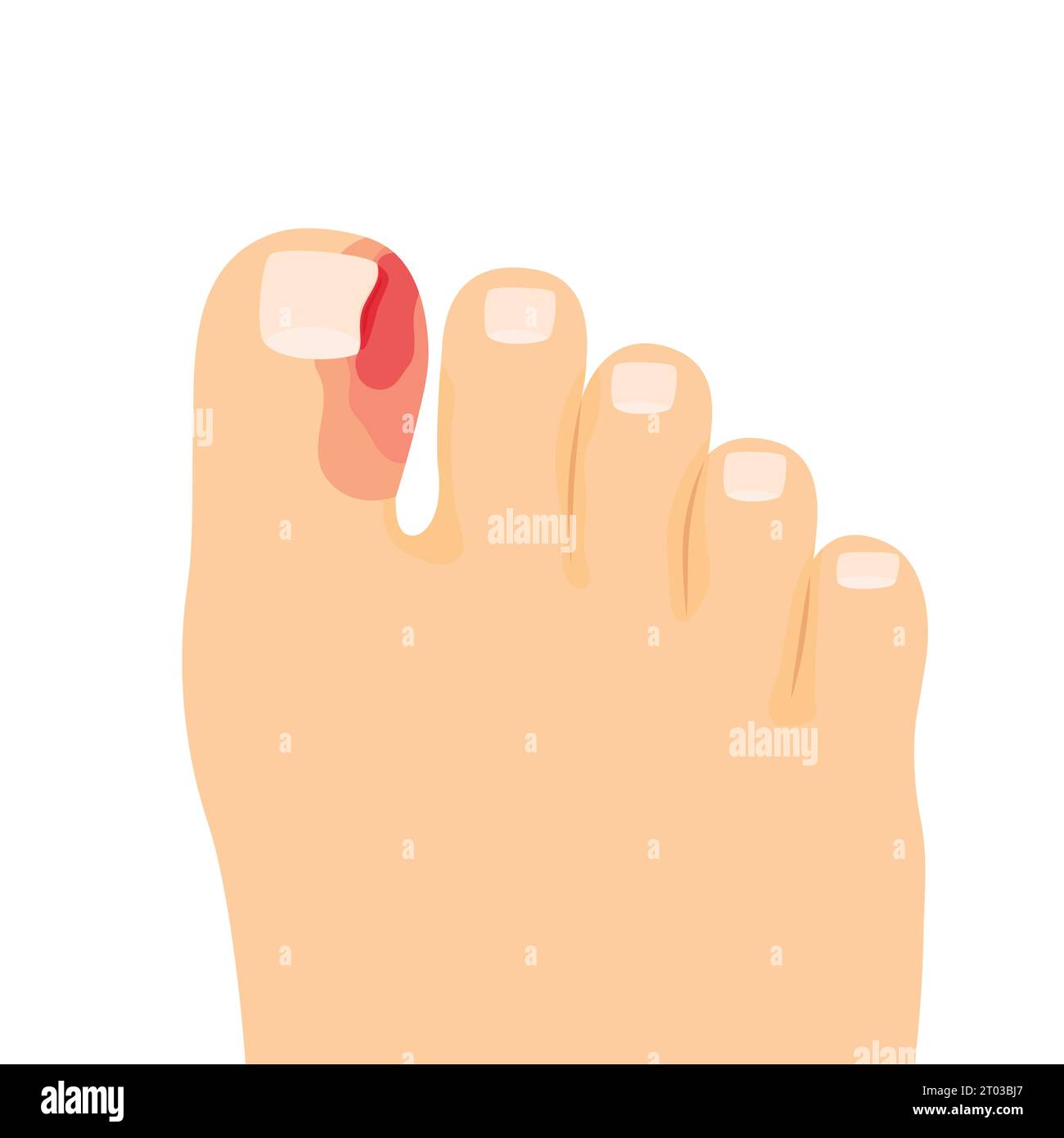 ingrown toenail, paronychia of the toe- vector illustration Stock ...