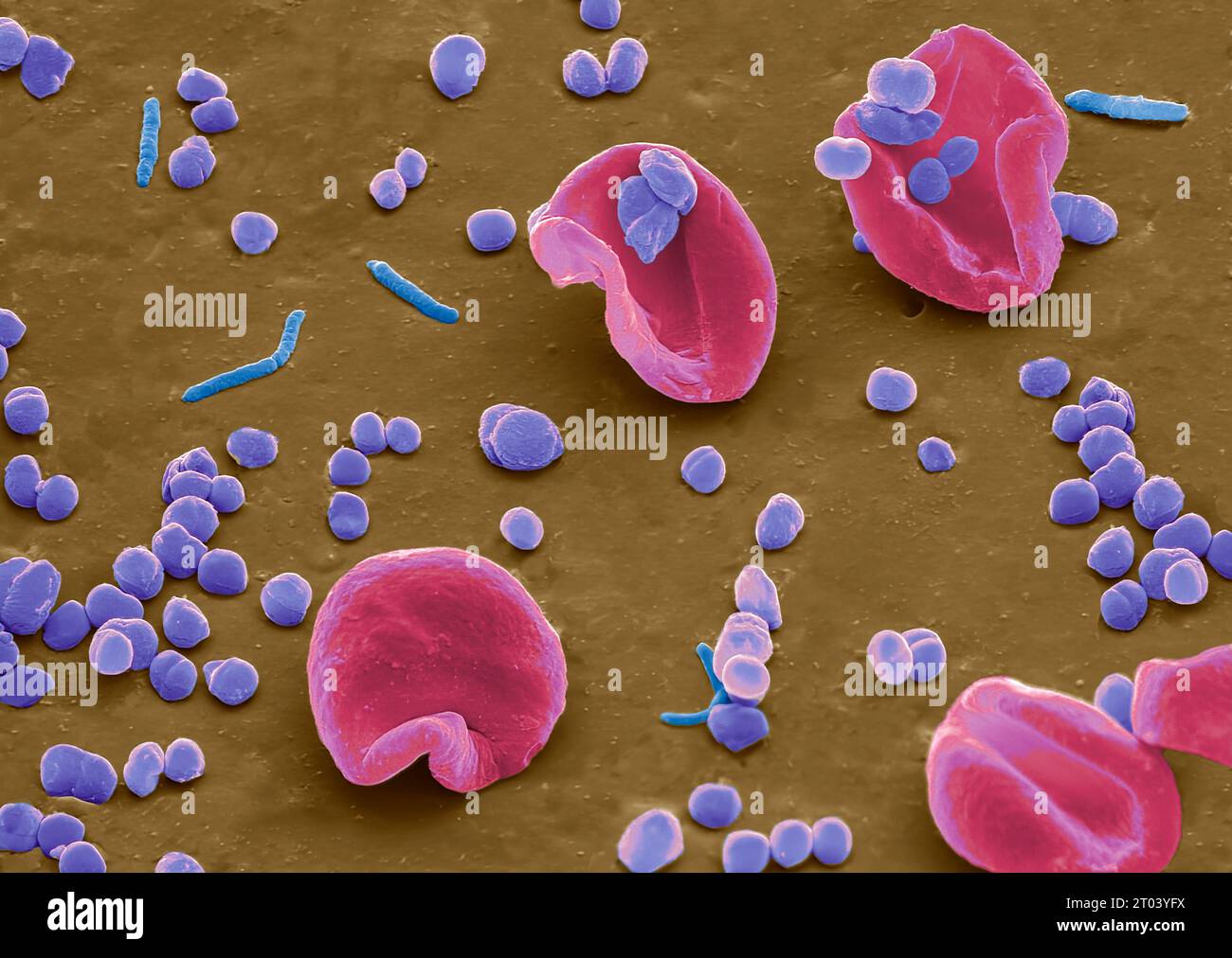 Infected PICC line. Coloured scanning electron micrograph (SEM) of the ...