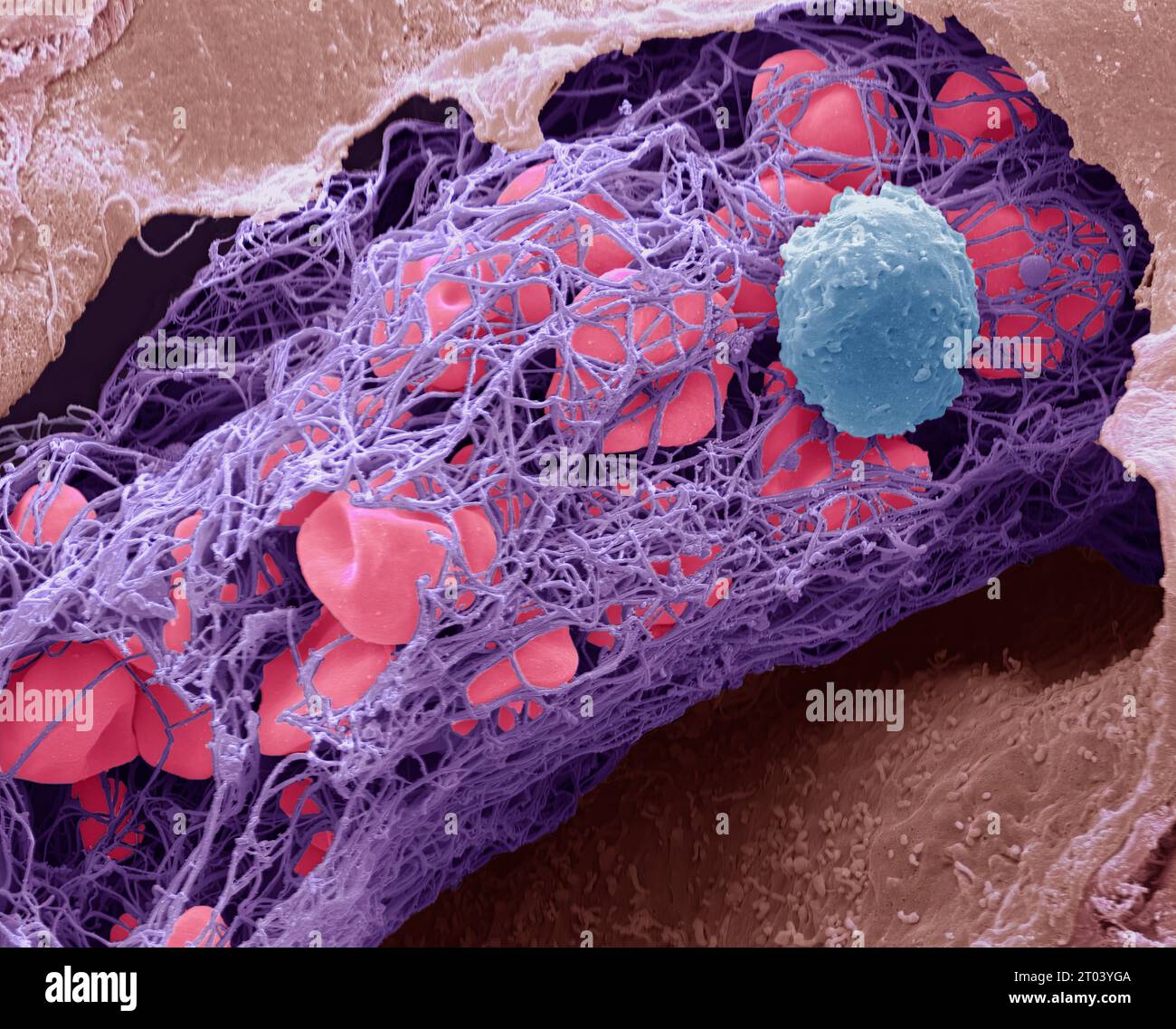 Blood clot. Coloured scanning electron micrograph (SEM) of a blood clot ...