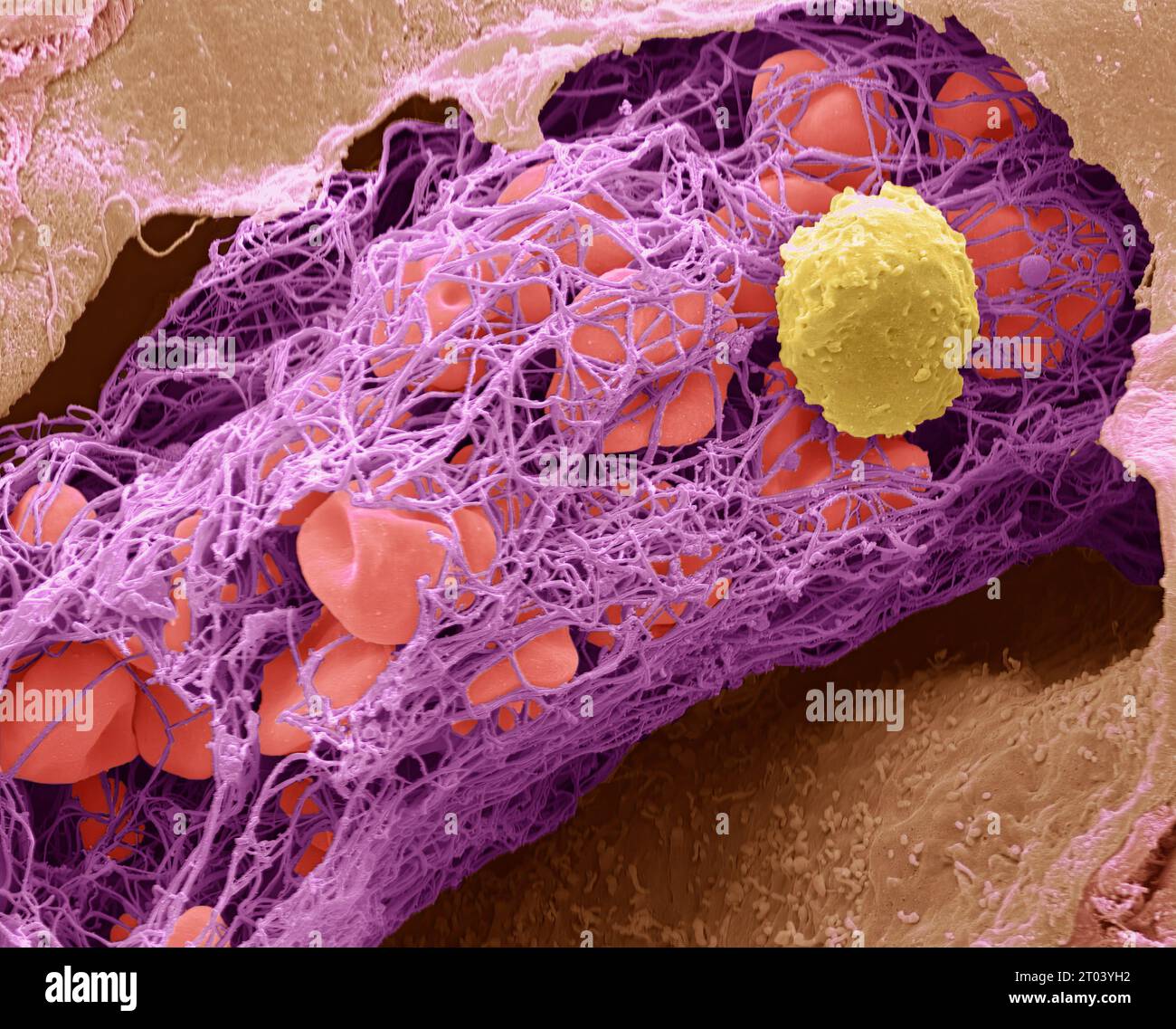 Blood clot. Coloured scanning electron micrograph (SEM) of a blood clot ...