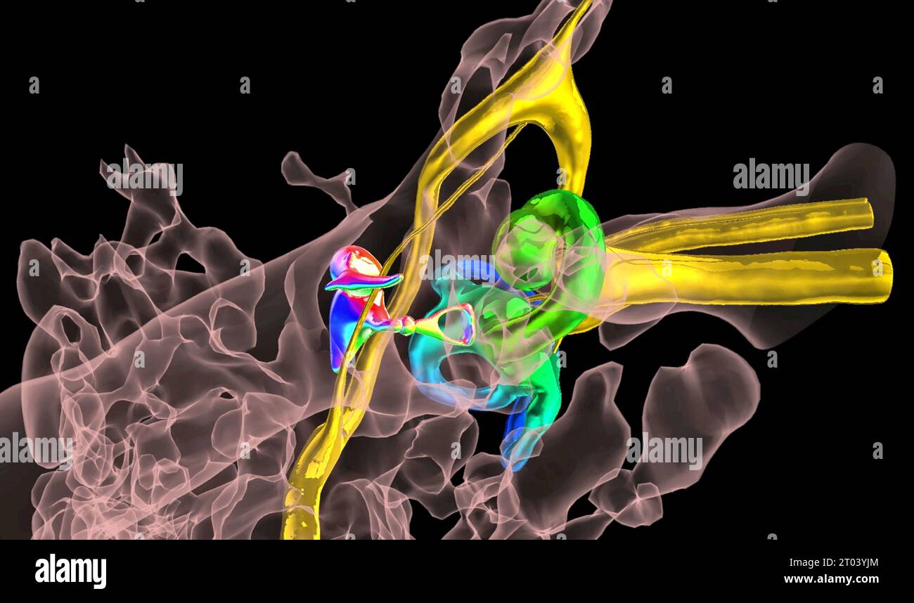 Coloured 3D composite computed tomography (CT) and magnetic resonance ...