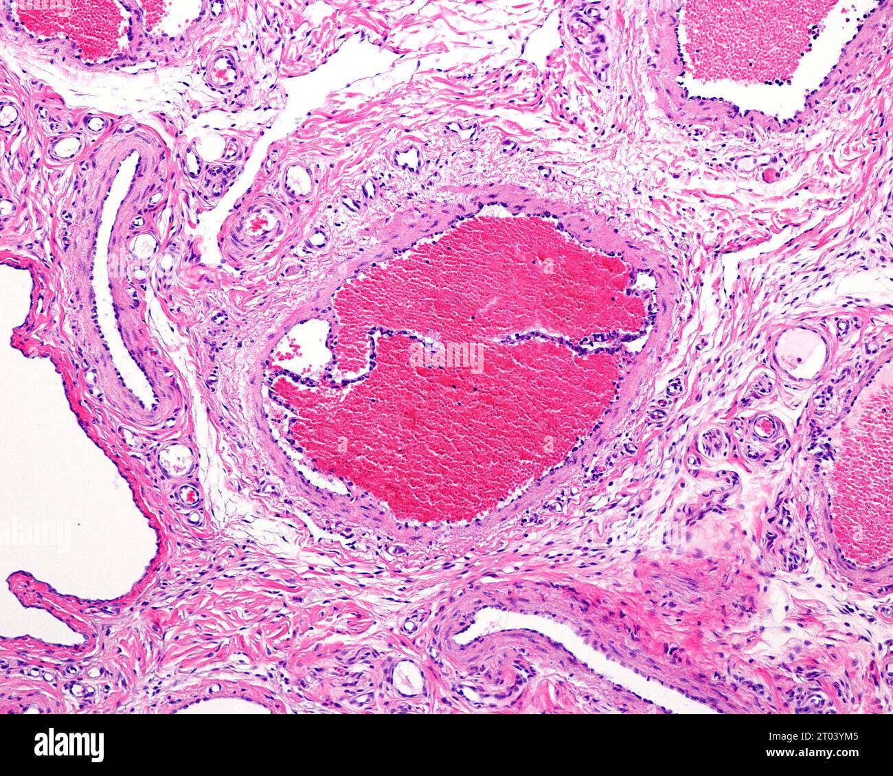 Light micrograph showing a venous valve with two leaflets located in a ...