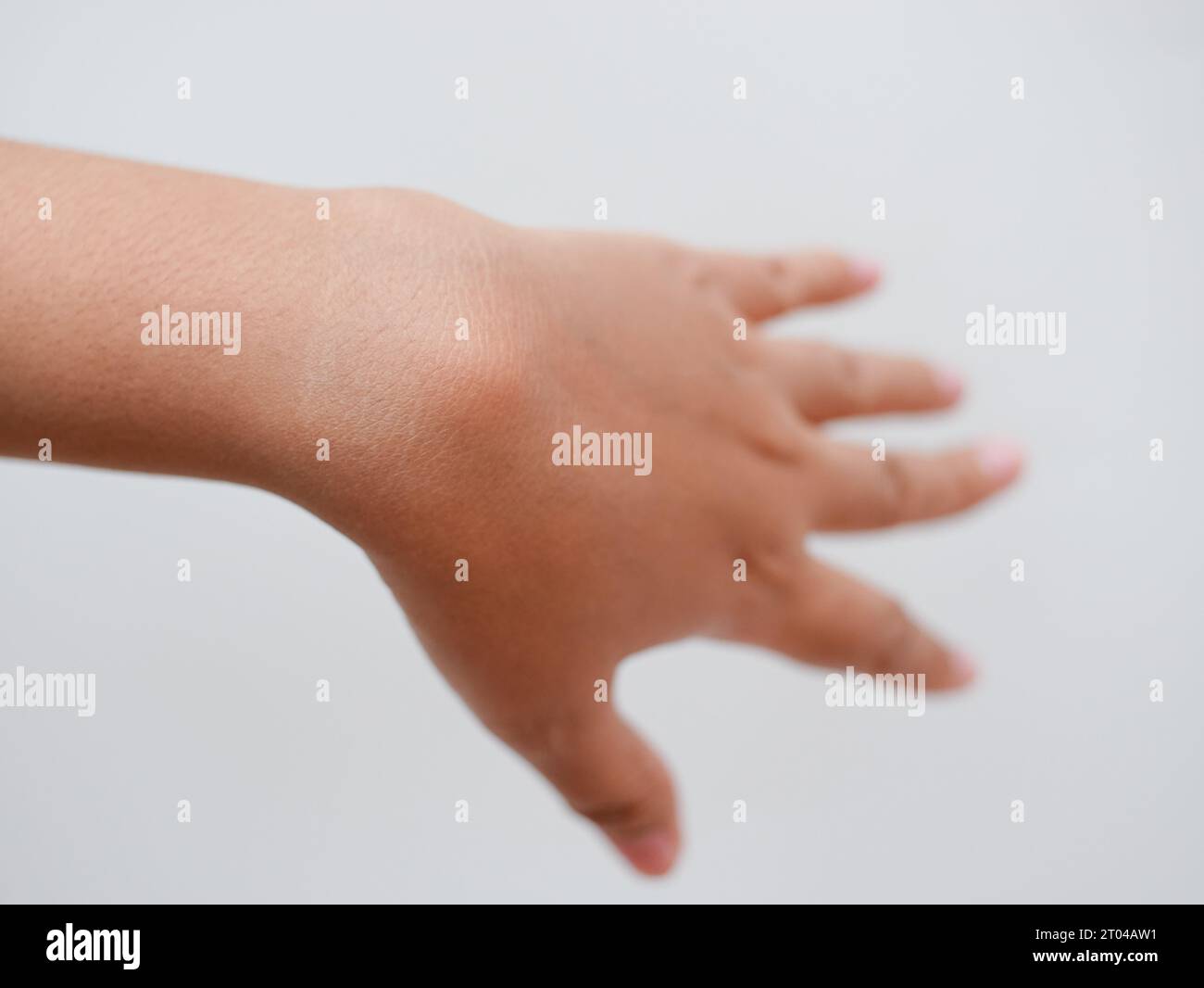 ganglion cyst on woman hand isolated on white background Stock Photo ...