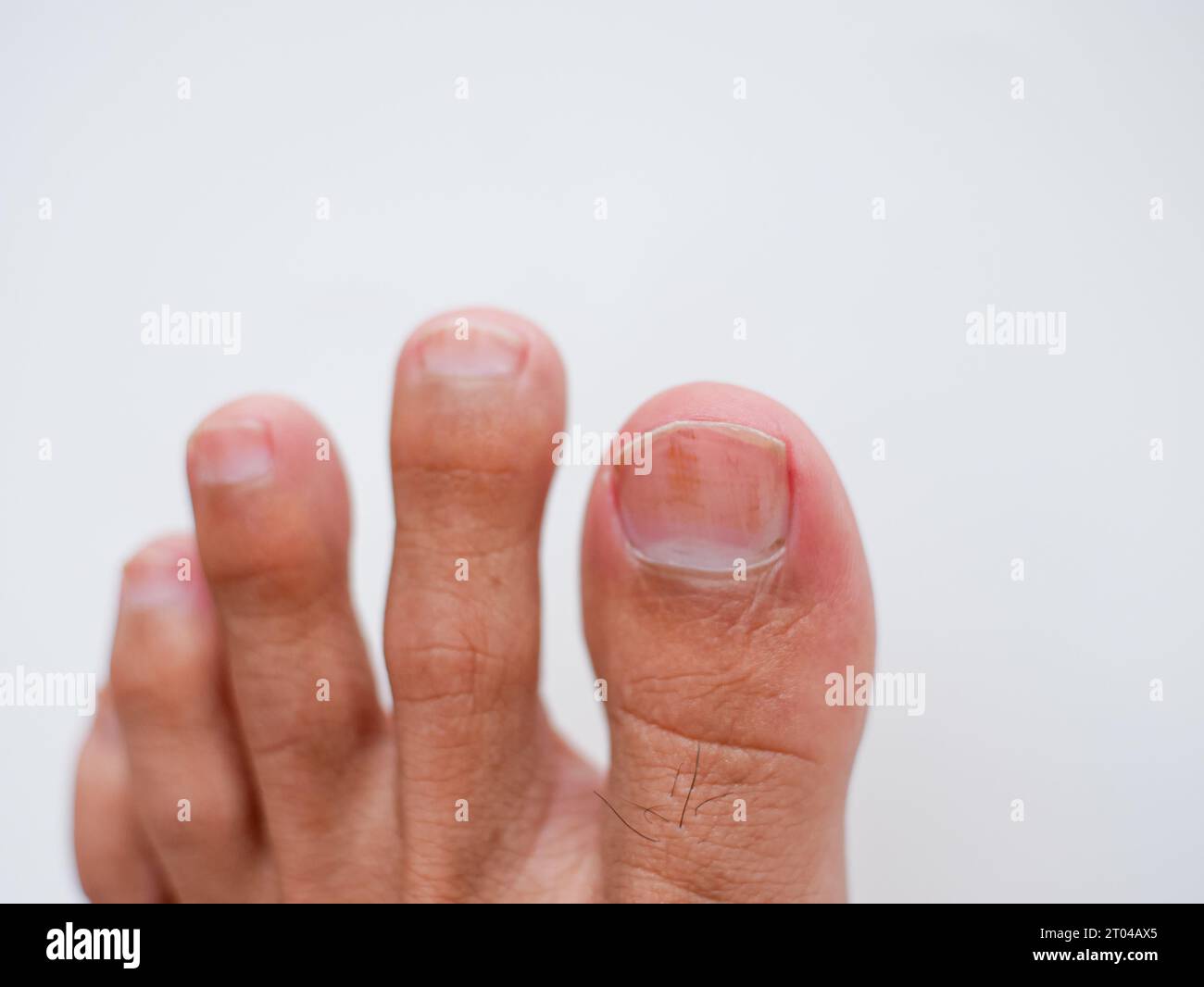 Toes with nail disease isolated on a white background Stock Photo - Alamy