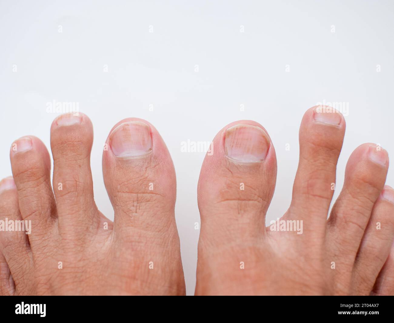 Toes with nail disease isolated on a white background Stock Photo - Alamy