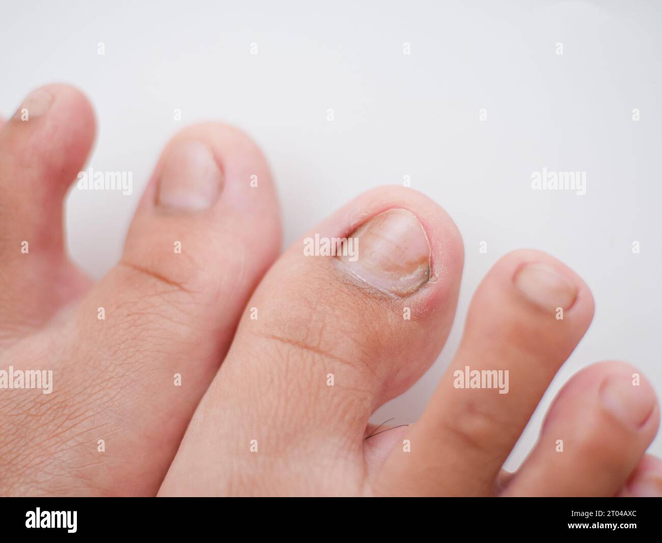 Toes with nail disease isolated on a white background Stock Photo - Alamy