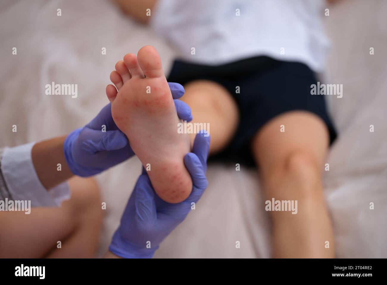 Infectious disease doctor examining rash on skin of child feet closeup ...