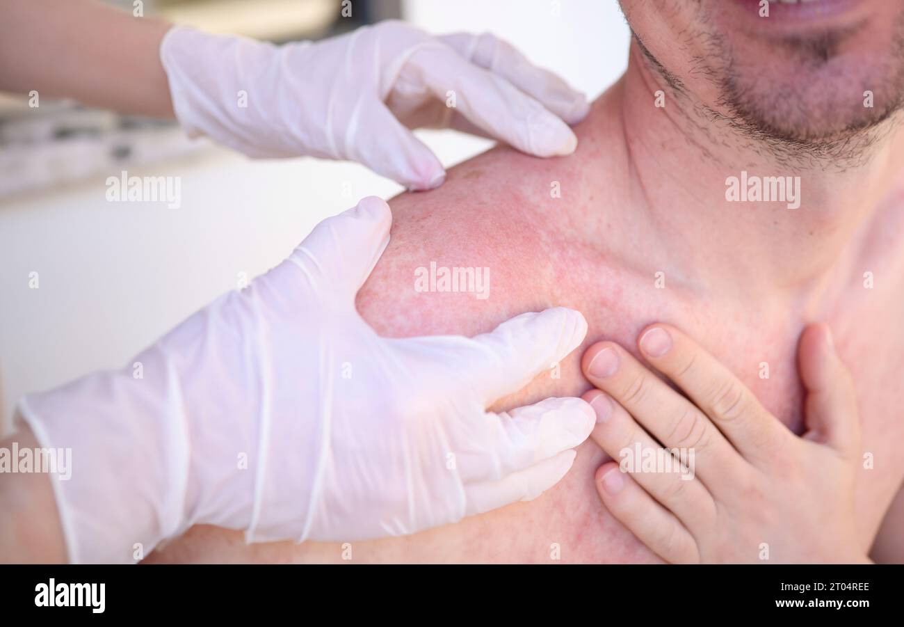 Doctor in gloves conducts initial examination of man with sunburn on ...