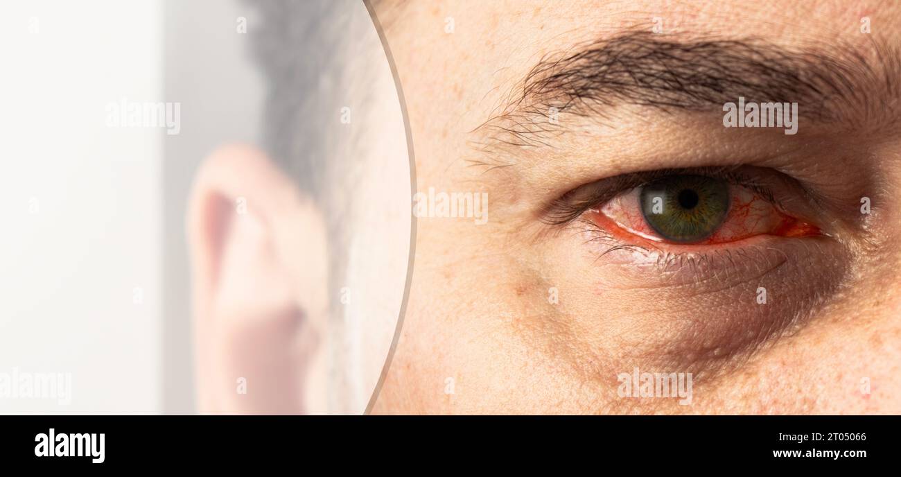Red eye in a person. A close-up of a heavily bloodshot eye. Ophthalmia ...