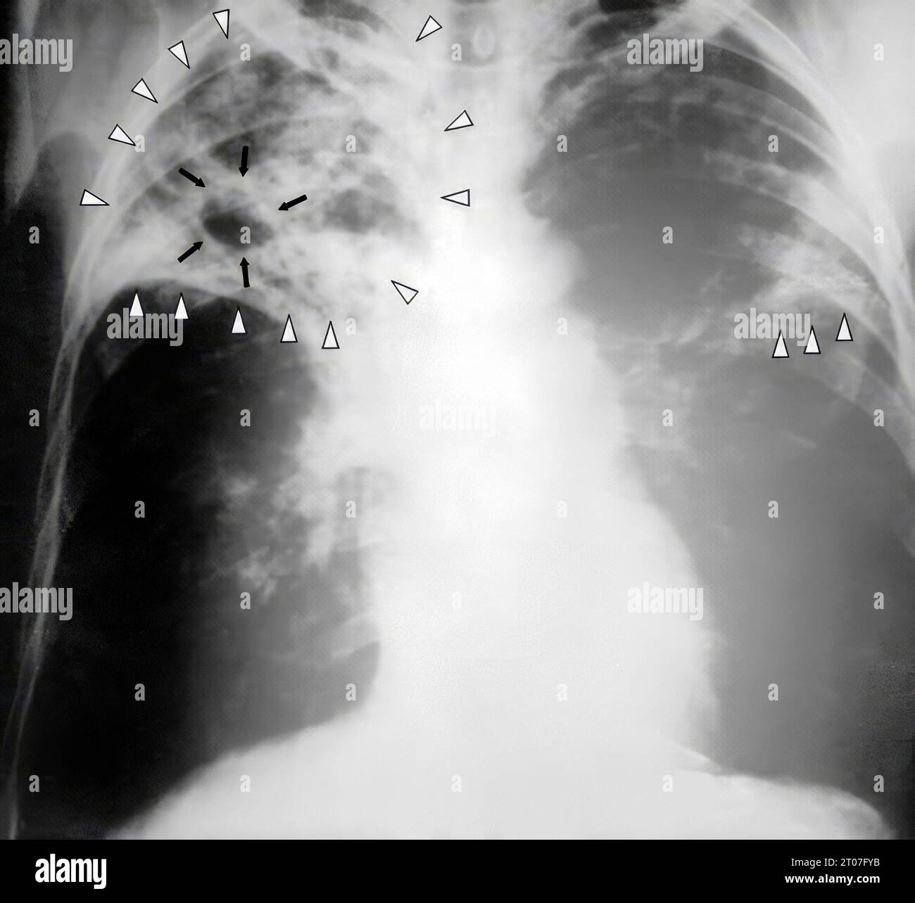 Pulmonary infiltrate hi-res stock photography and images - Alamy