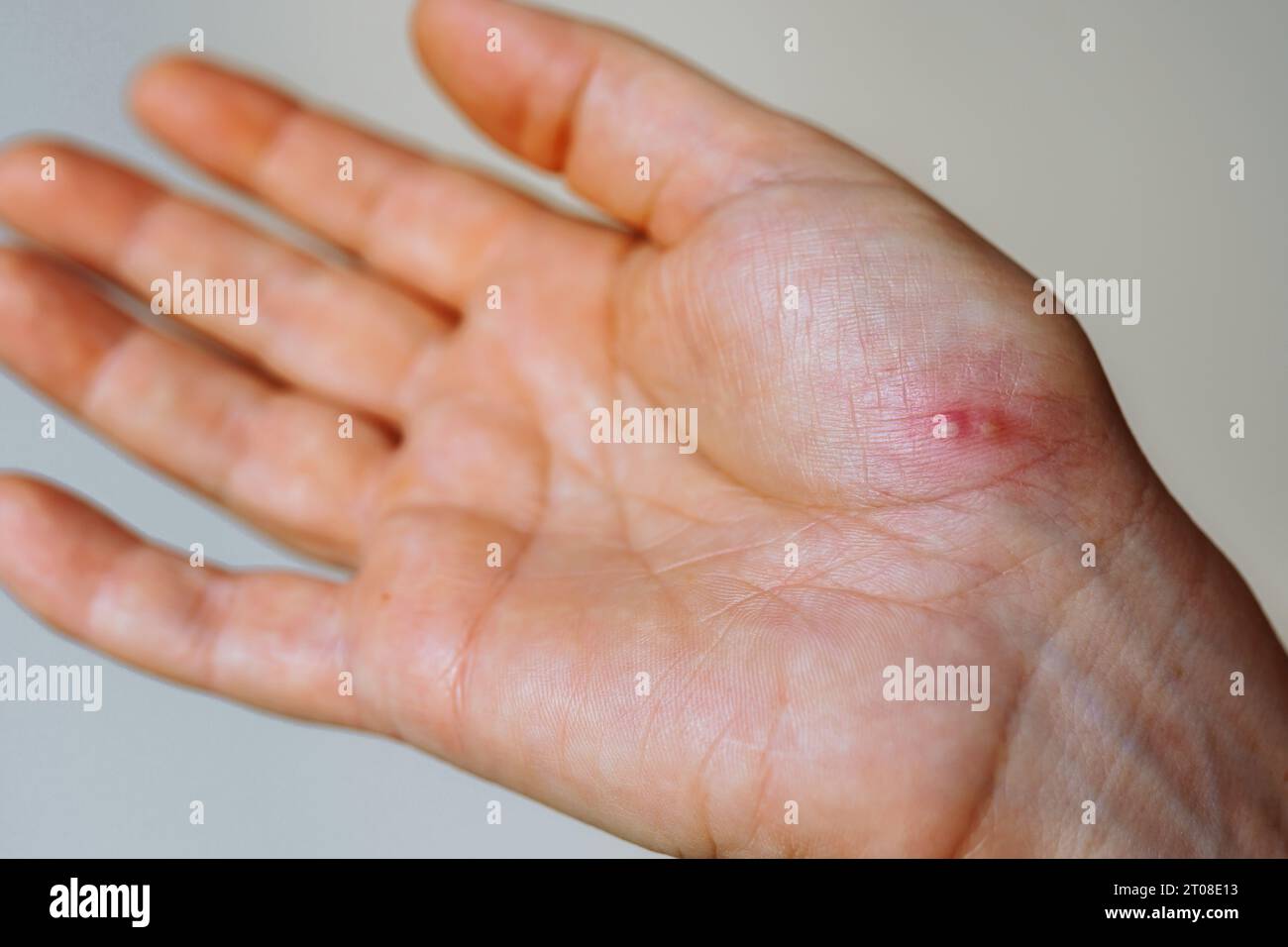Eczema herpes zoster hi-res stock photography and images - Alamy