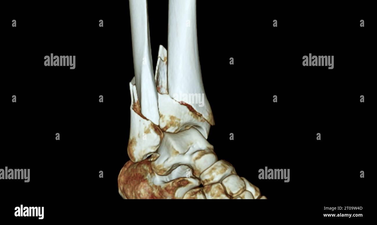 CT Scan ankle joint 3D Rendering image showing fracture tibia and ...