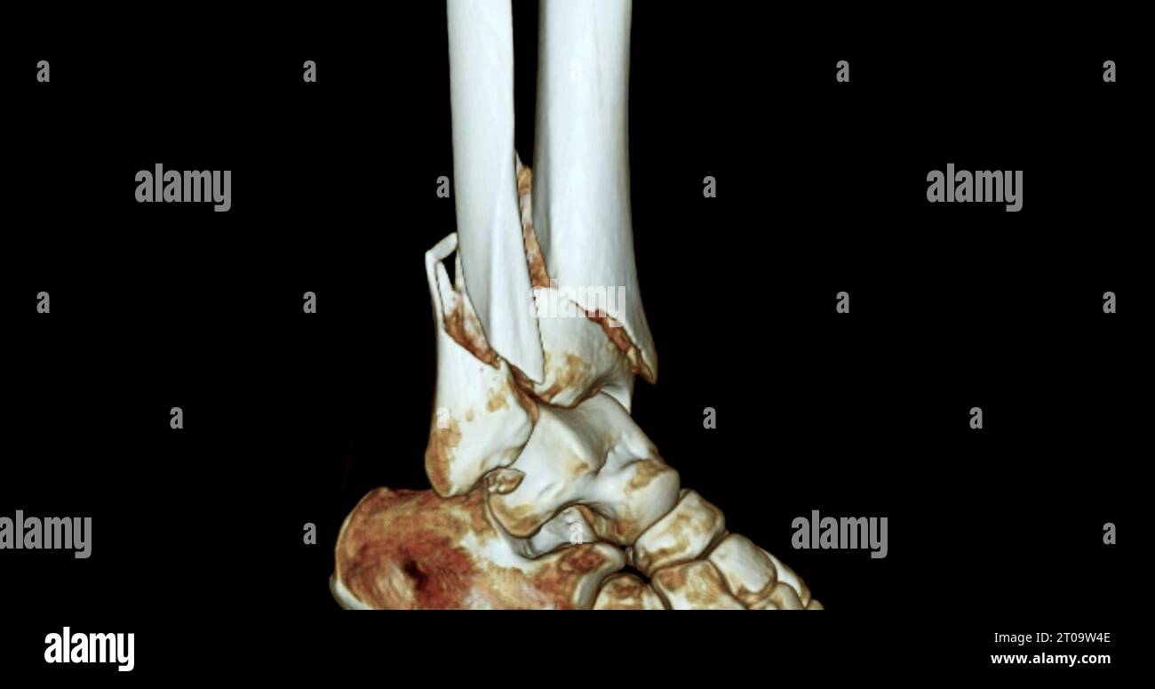 Ankle joint isolated plantar hi-res stock photography and images - Alamy
