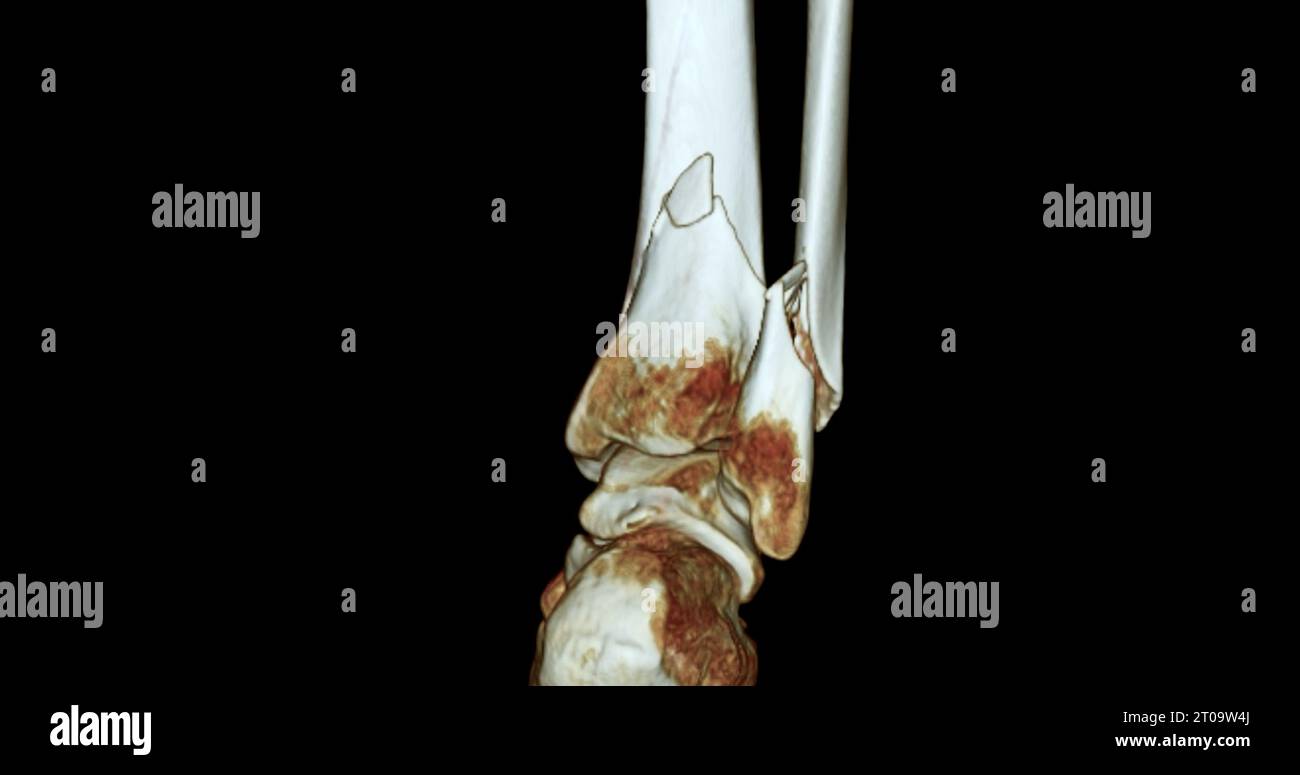 CT Scan ankle joint 3D Rendering image showing fracture tibia and ...
