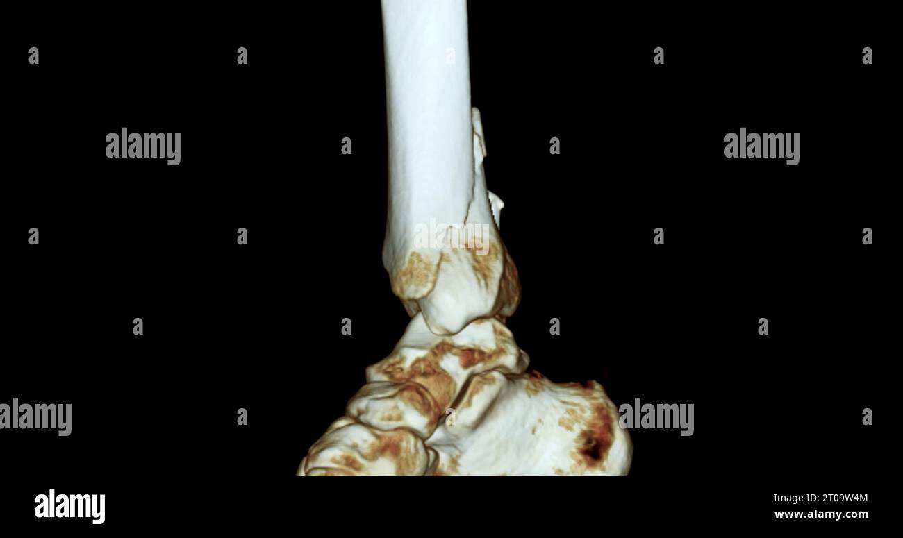 CT Scan ankle joint 3D Rendering image showing fracture tibia and ...