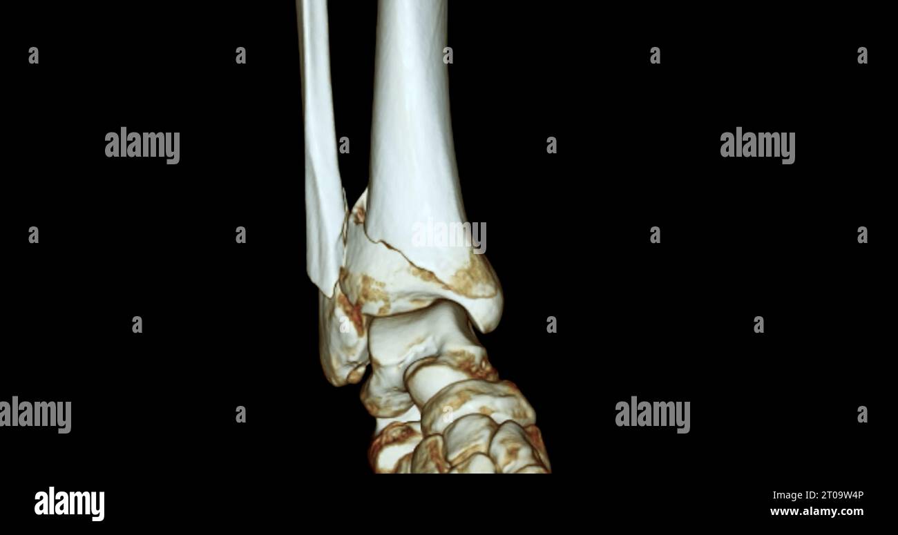 CT Scan ankle joint 3D Rendering image showing fracture tibia and ...