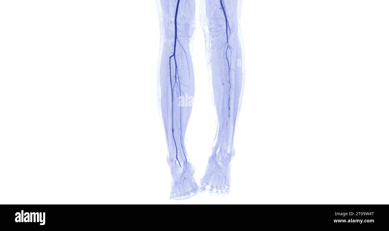 CTA femoral artery run off image of femoral artery for diagnostic Acute ...