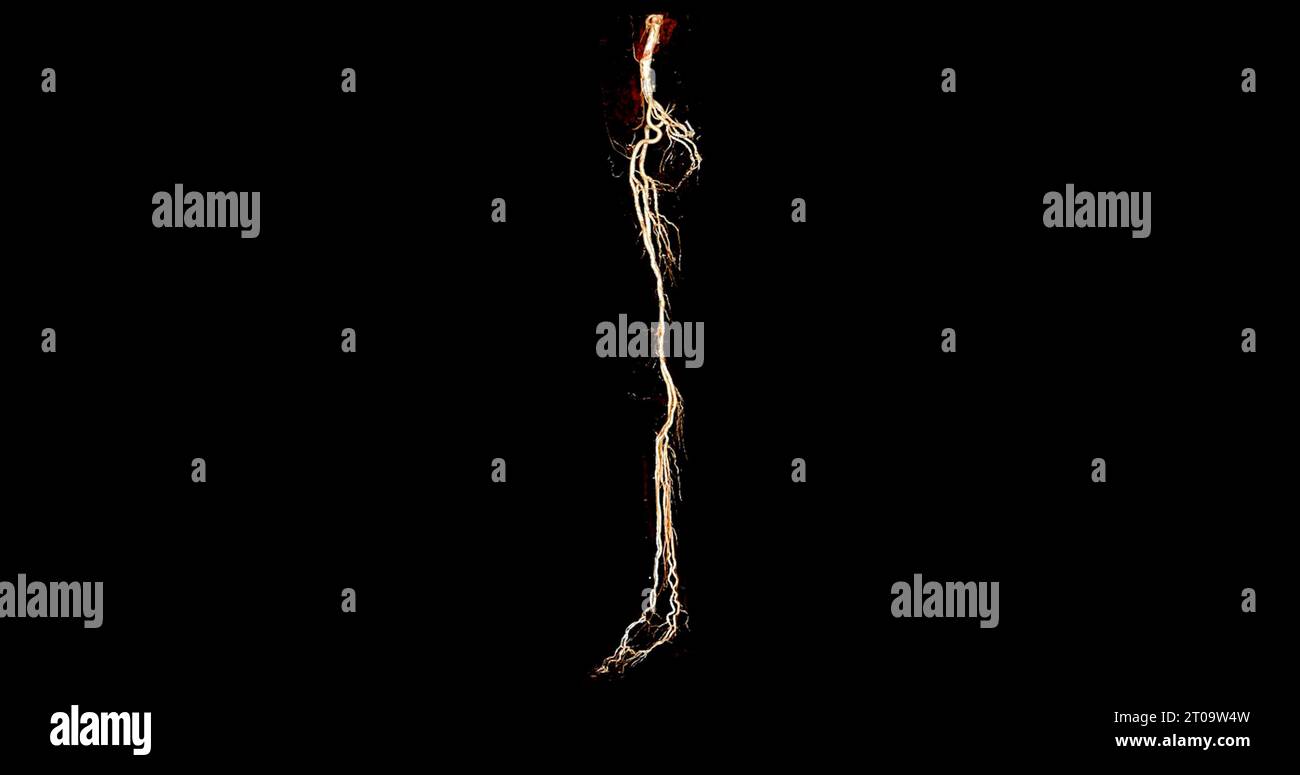 CTA femoral artery run off image of femoral artery for diagnostic Acute ...