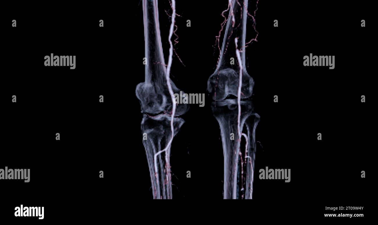 CTA femoral artery run off image of femoral artery for diagnostic Acute ...