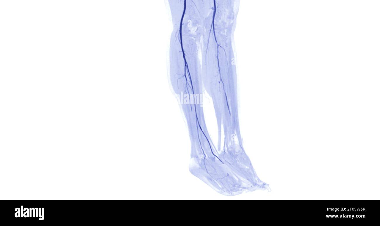 CTA femoral artery run off image of femoral artery for diagnostic Acute ...
