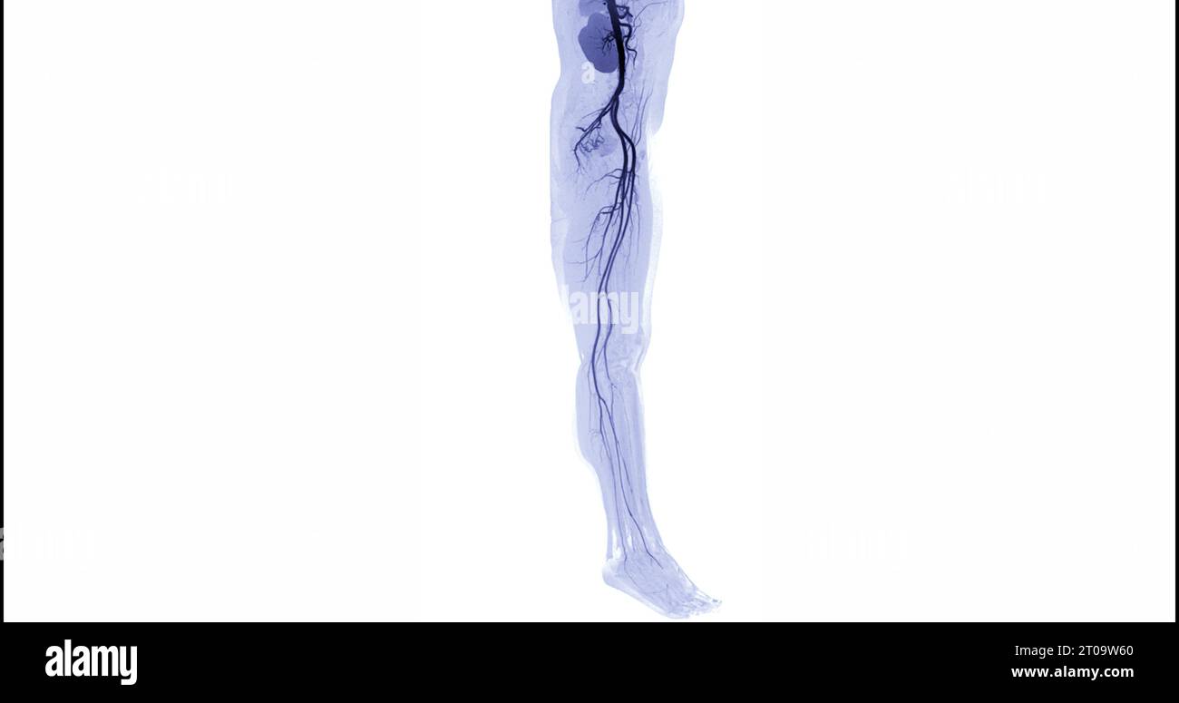 CTA femoral artery run off image of femoral artery for diagnostic Acute ...