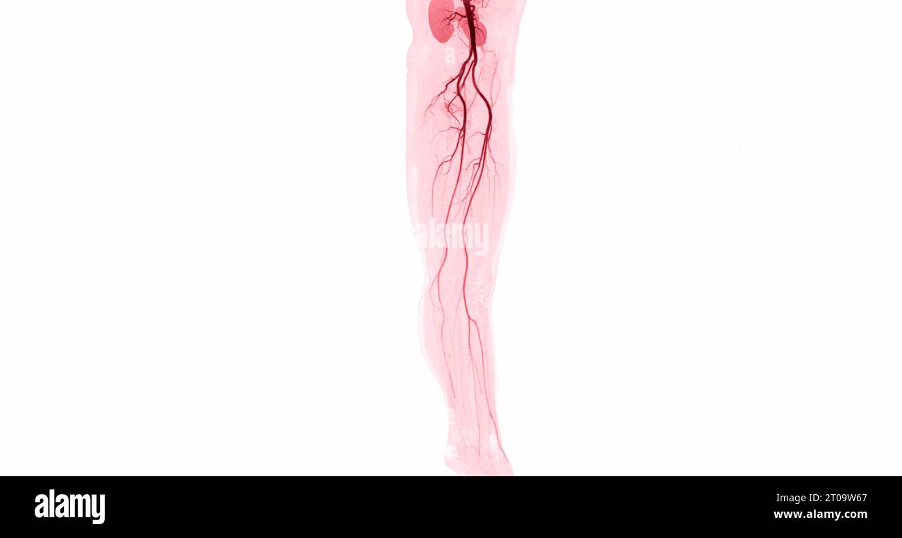 CTA femoral artery run off image of femoral artery for diagnostic Acute ...