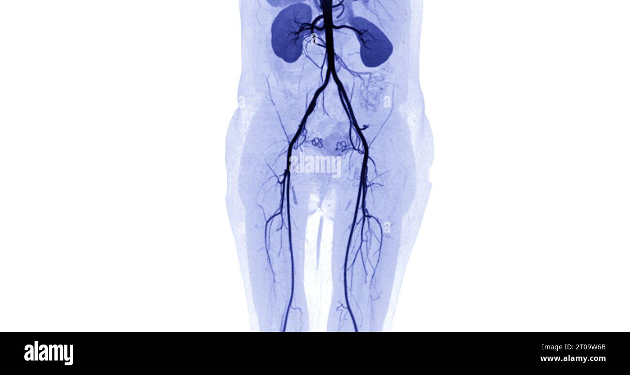 CTA femoral artery run off image of femoral artery for diagnostic Acute ...