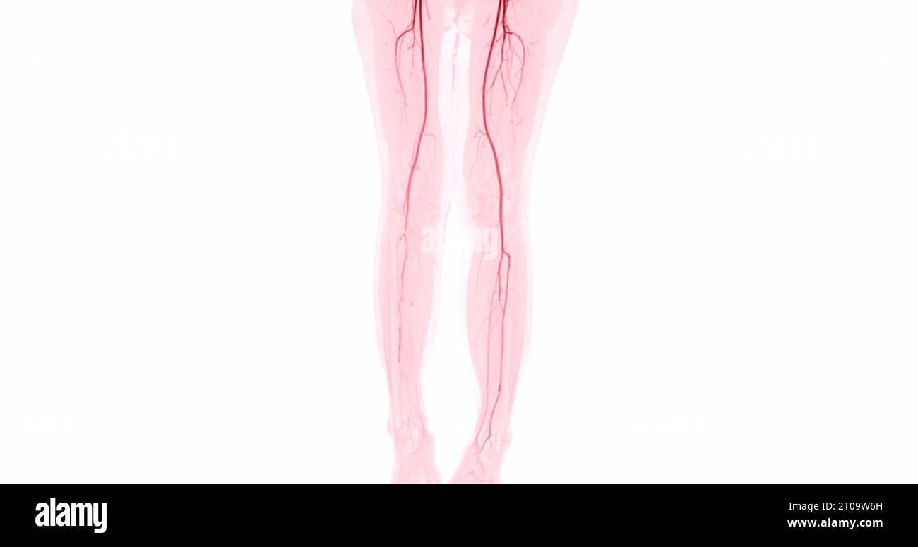 CTA femoral artery run off image of femoral artery for diagnostic Acute ...