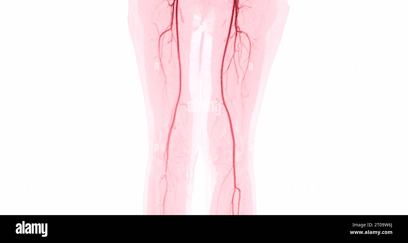 CTA femoral artery run off image of femoral artery for diagnostic Acute ...