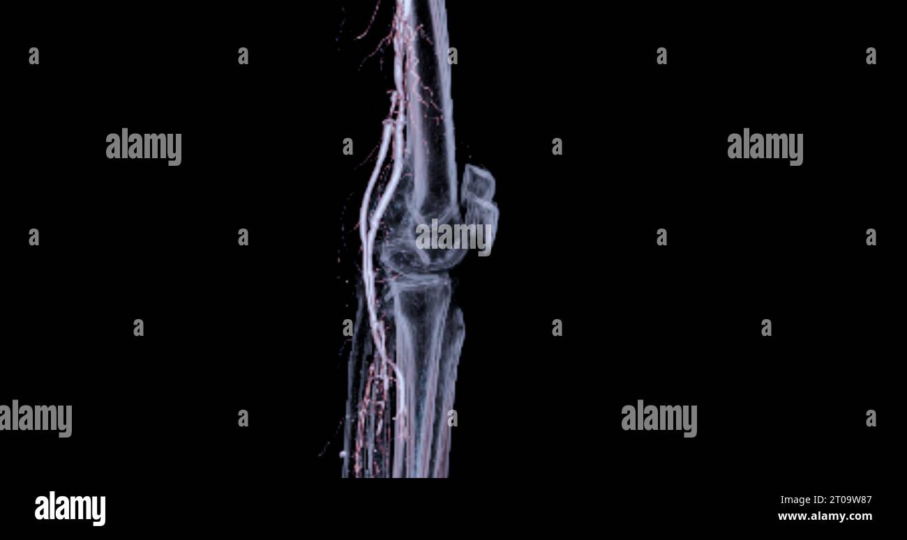 CTA femoral artery run off image of femoral artery for diagnostic Acute ...
