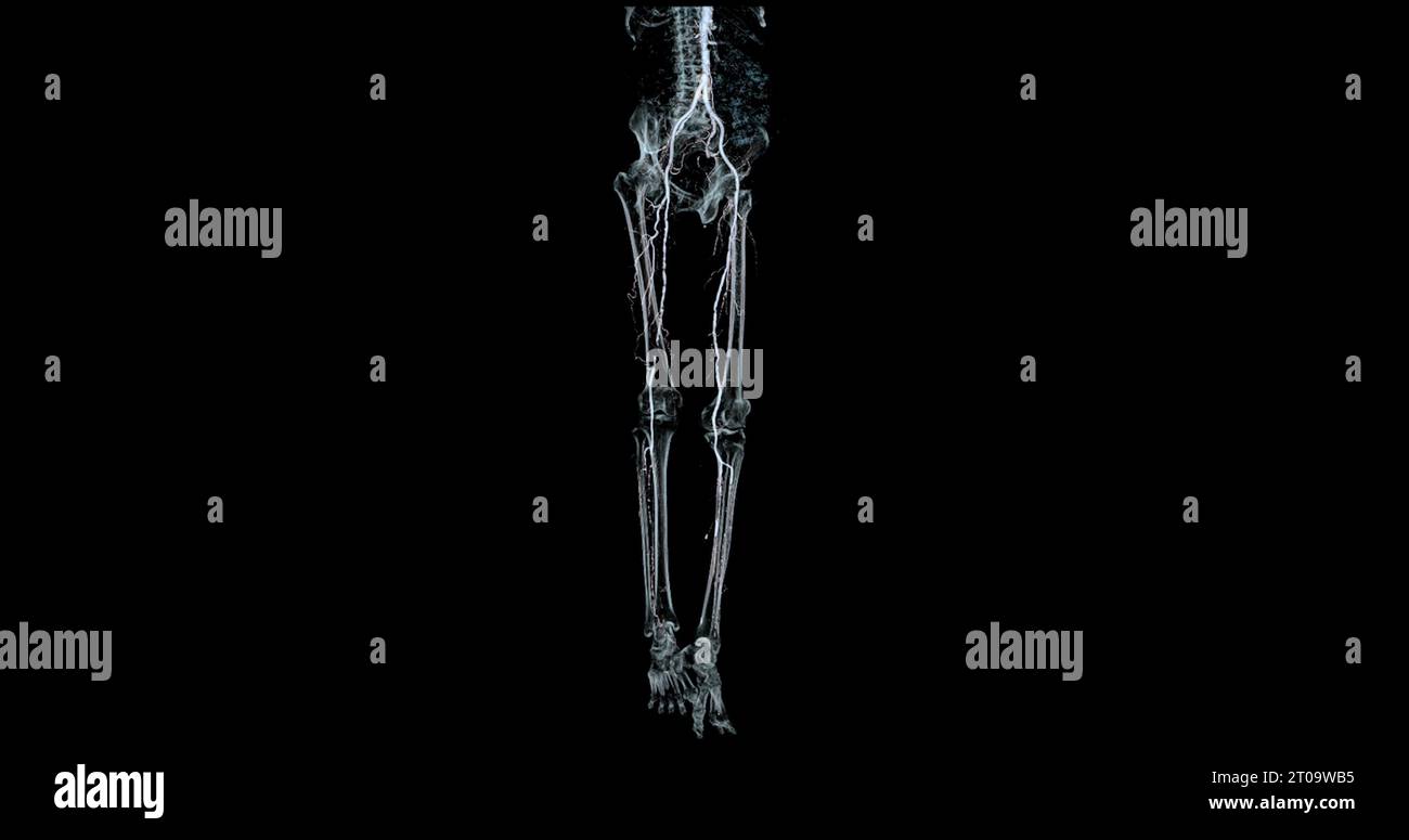 CTA femoral artery run off image of femoral artery for diagnostic Acute ...