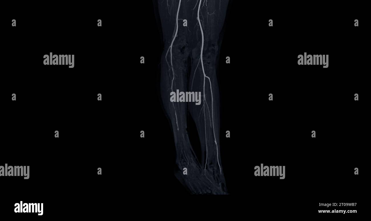 CTA femoral artery run off image of femoral artery for diagnostic Acute ...