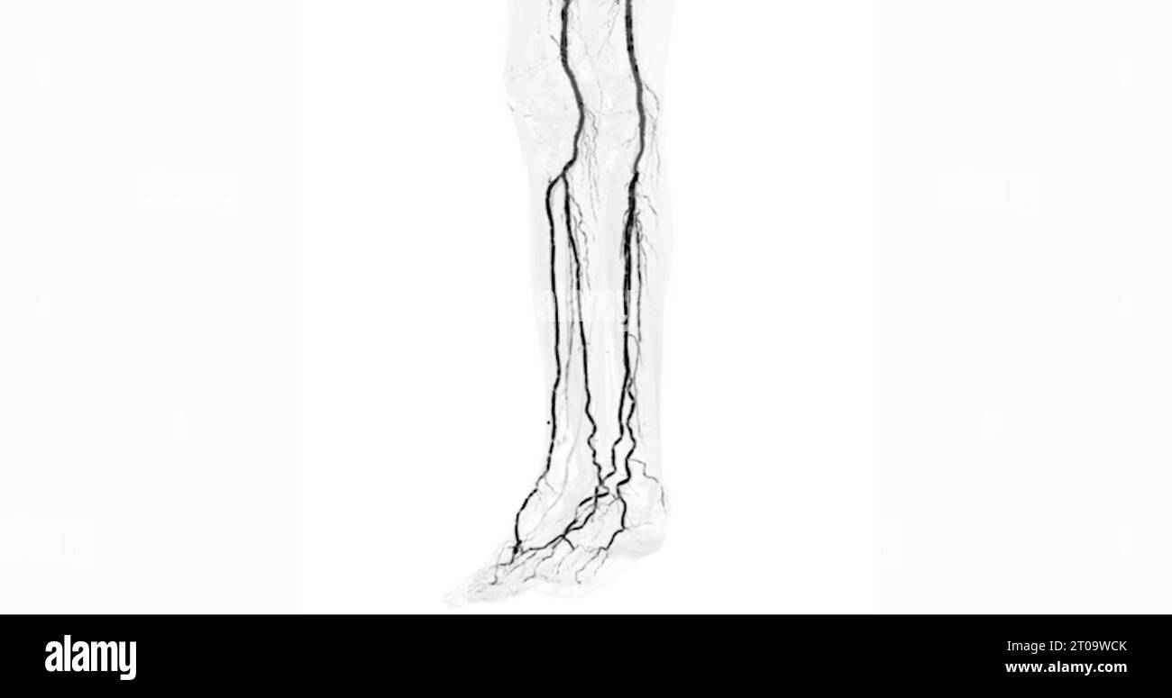 CTA femoral artery run off image of femoral artery for diagnostic Acute ...