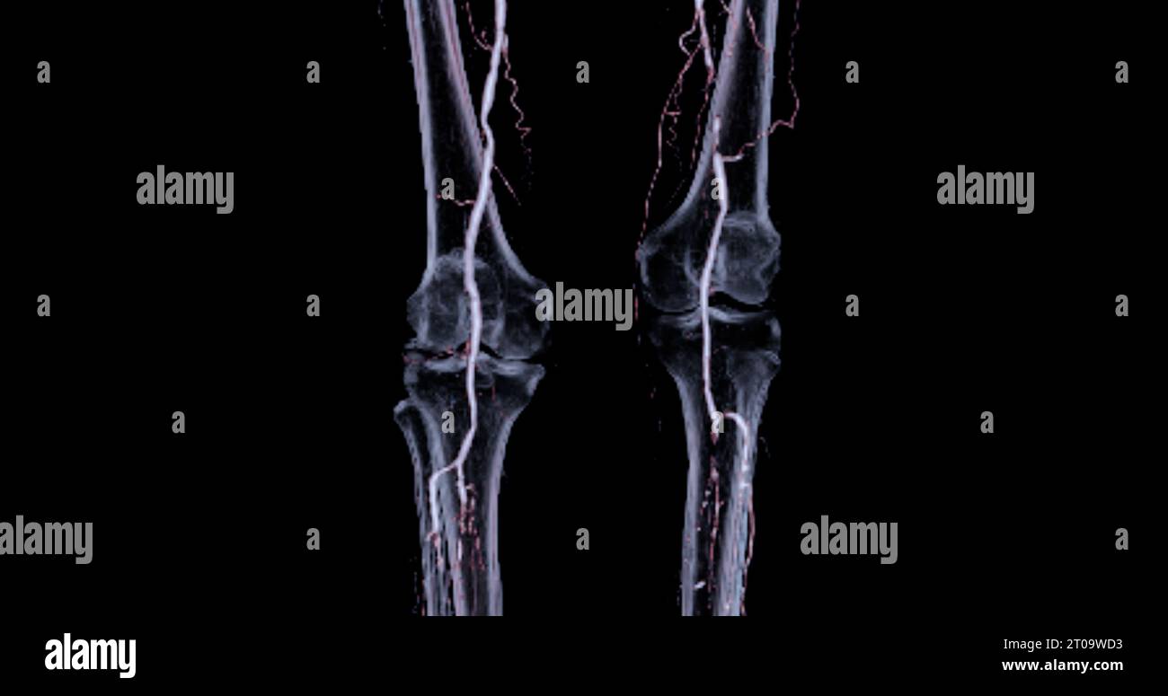 CTA femoral artery run off image of femoral artery for diagnostic Acute ...
