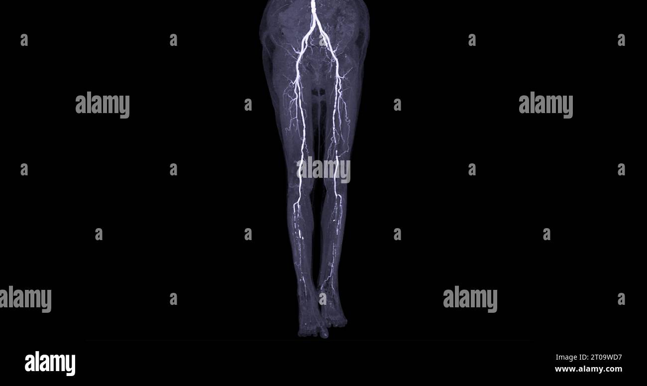 CTA femoral artery run off image of femoral artery for diagnostic Acute ...