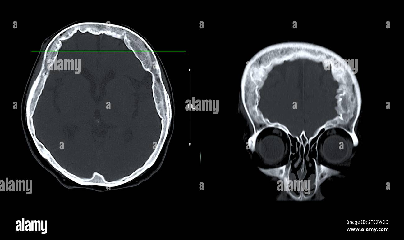 CT scan of the brain sagittal view for diagnosis brain tumor,stroke ...