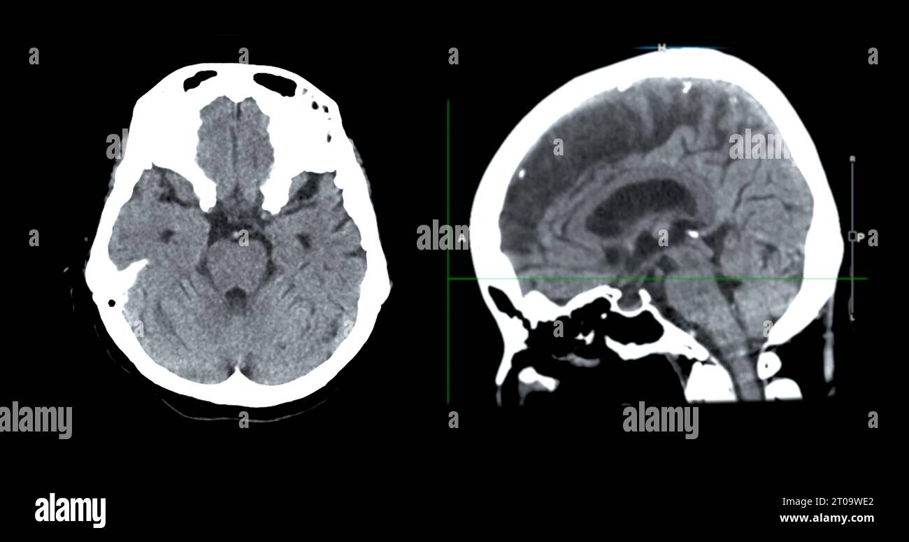 CT scan of the brain sagittal view for diagnosis brain tumor,stroke ...