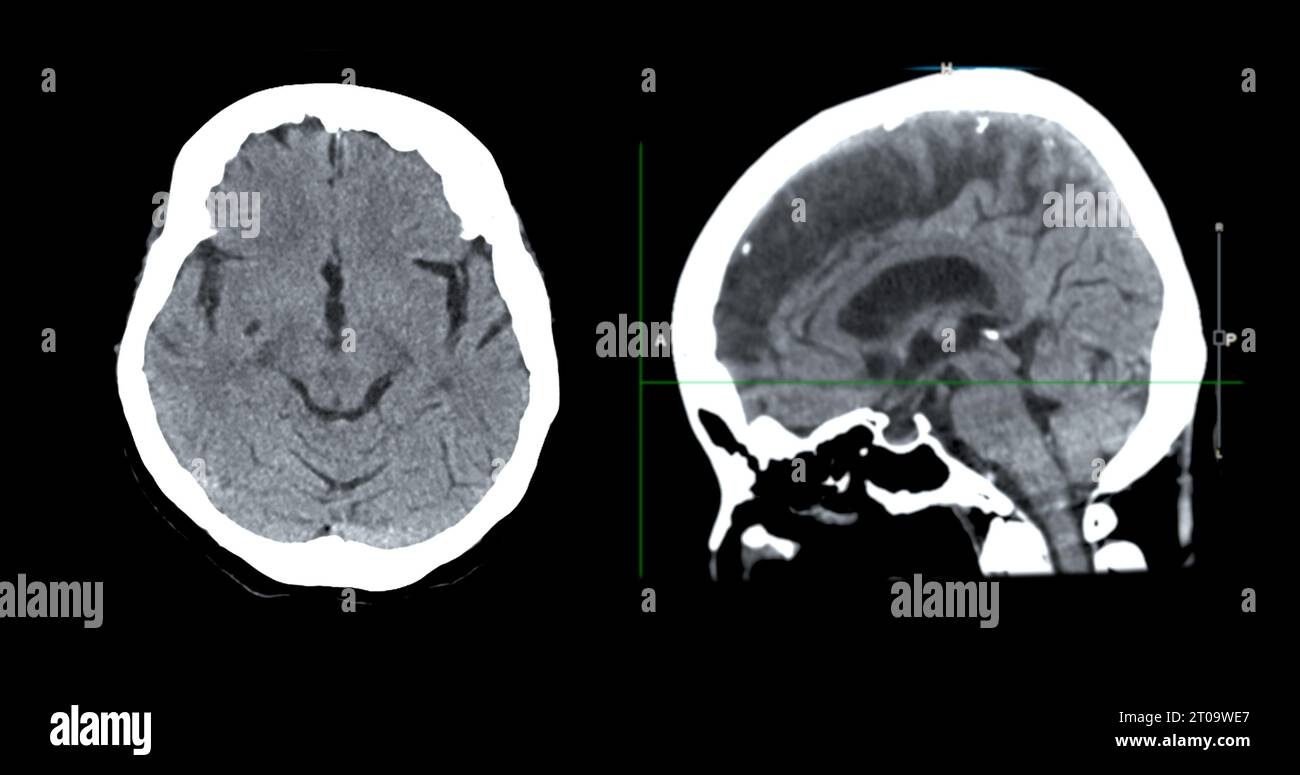 CT scan of the brain sagittal view for diagnosis brain tumor,stroke ...