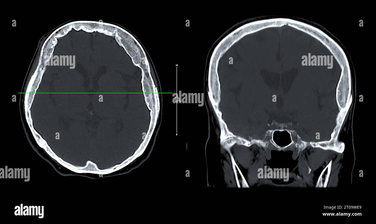 CT scan of the brain sagittal view for diagnosis brain tumor,stroke ...