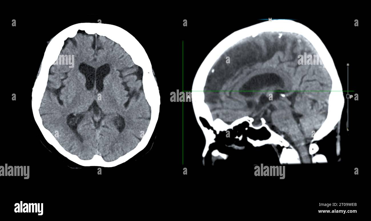 CT scan of the brain sagittal view for diagnosis brain tumor,stroke ...