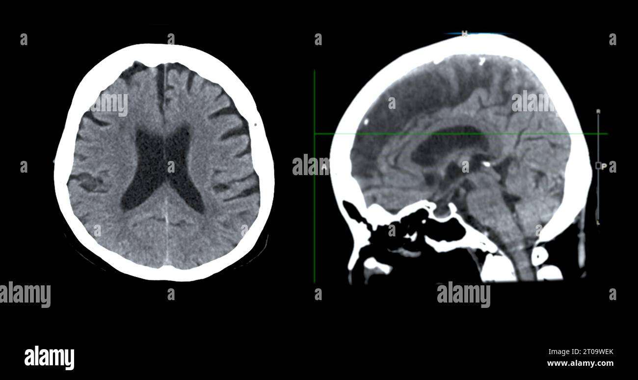 CT scan of the brain sagittal view for diagnosis brain tumor,stroke ...