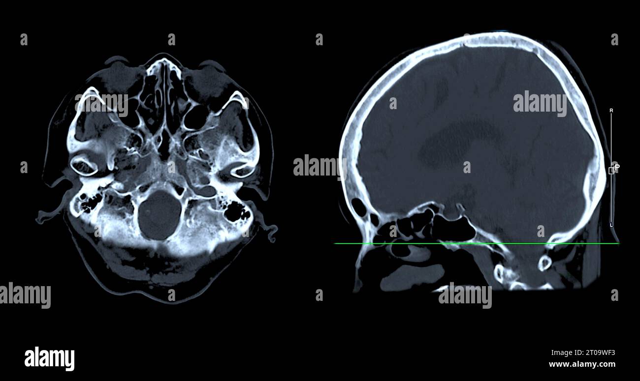 CT scan of the brain sagittal view for diagnosis brain tumor,stroke ...