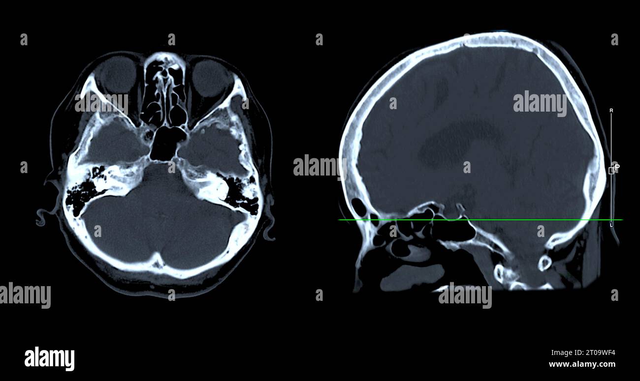 CT scan of the brain sagittal view for diagnosis brain tumor,stroke ...