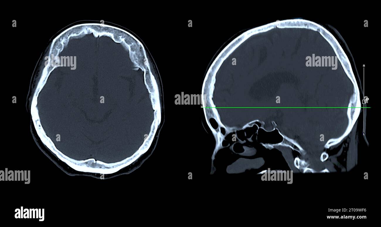 CT scan of the brain sagittal view for diagnosis brain tumor,stroke ...