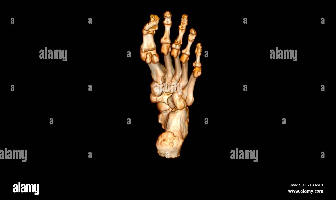 Foot 3D Scan for diagnosis foot diseases by CT-SCANNER Stock Photo - Alamy