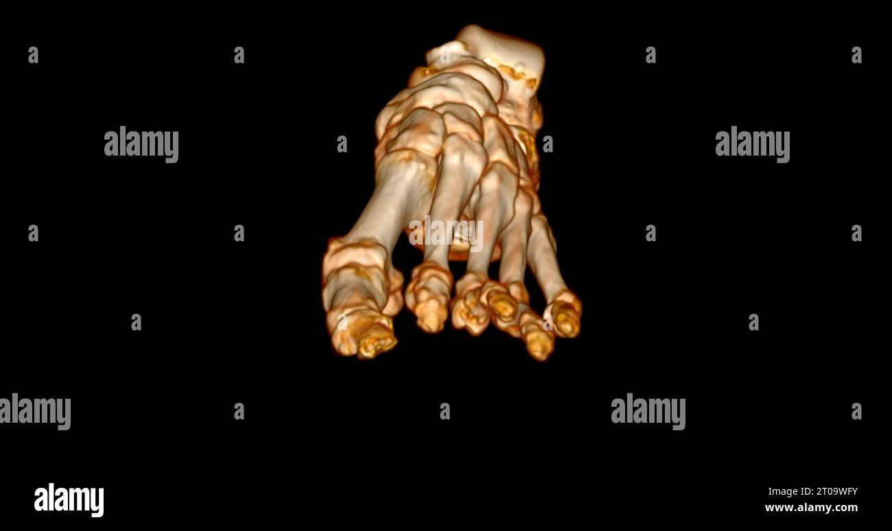 Foot 3D Scan for diagnosis foot diseases by CT-SCANNER Stock Photo - Alamy