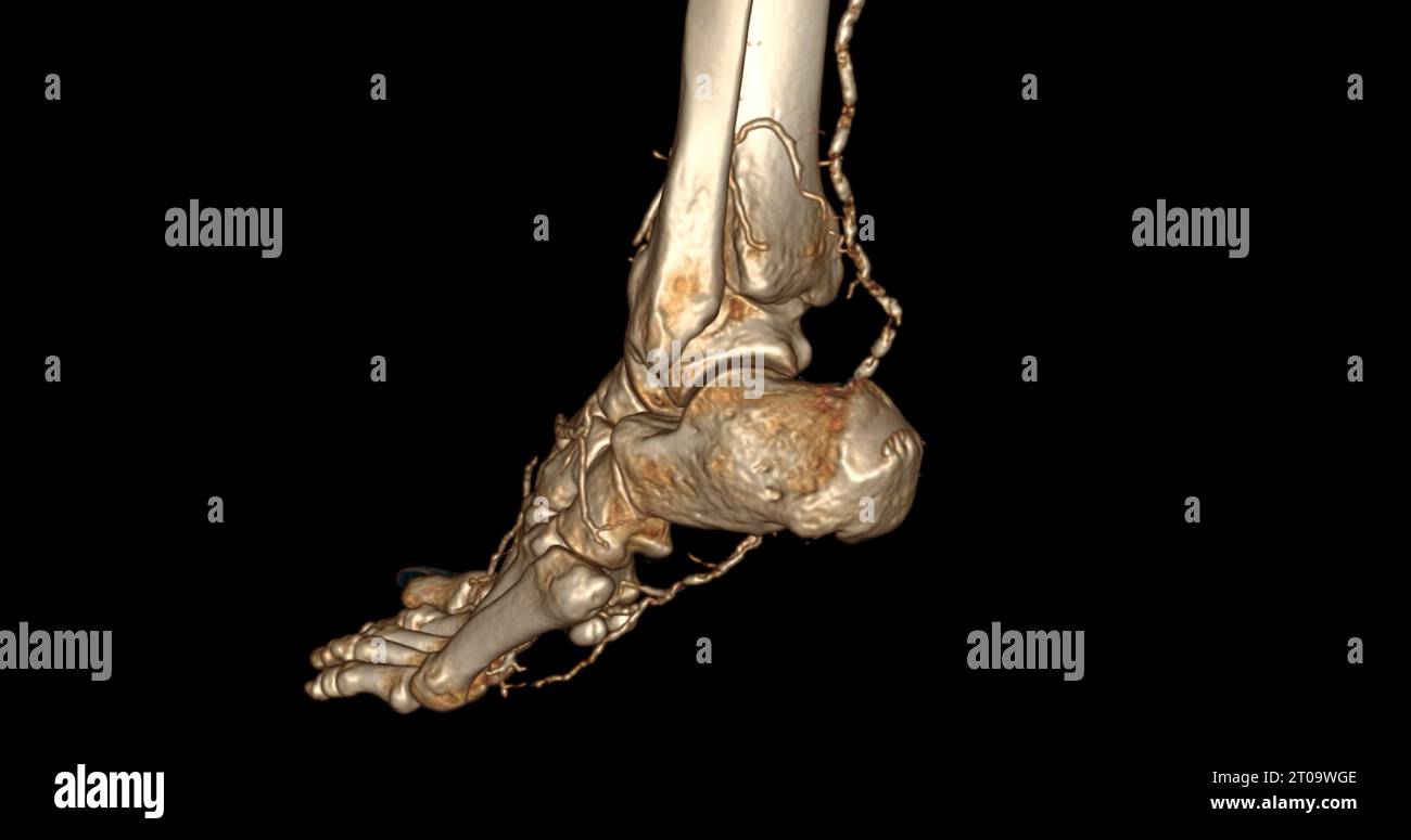 Foot 3D Scan for diagnosis foot diseases by CT-SCANNER Stock Photo - Alamy