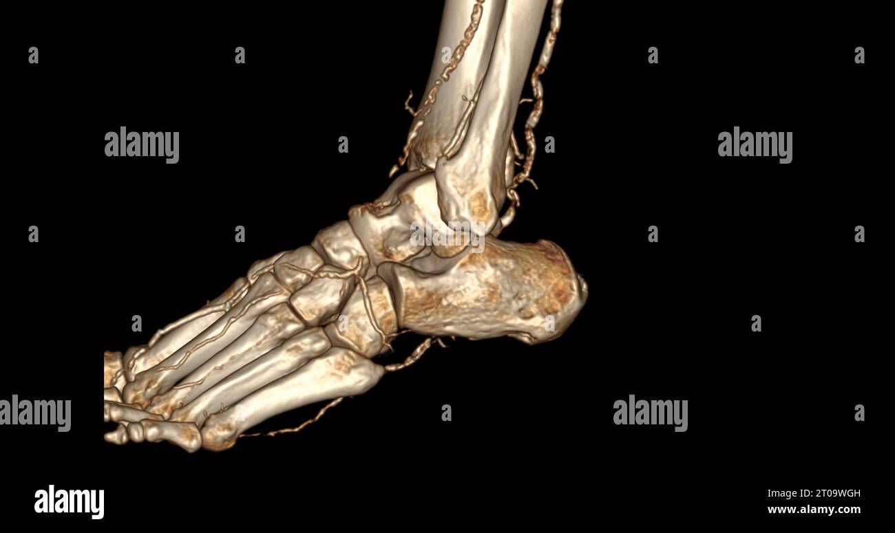 Foot 3D Scan for diagnosis foot diseases by CT-SCANNER Stock Photo - Alamy