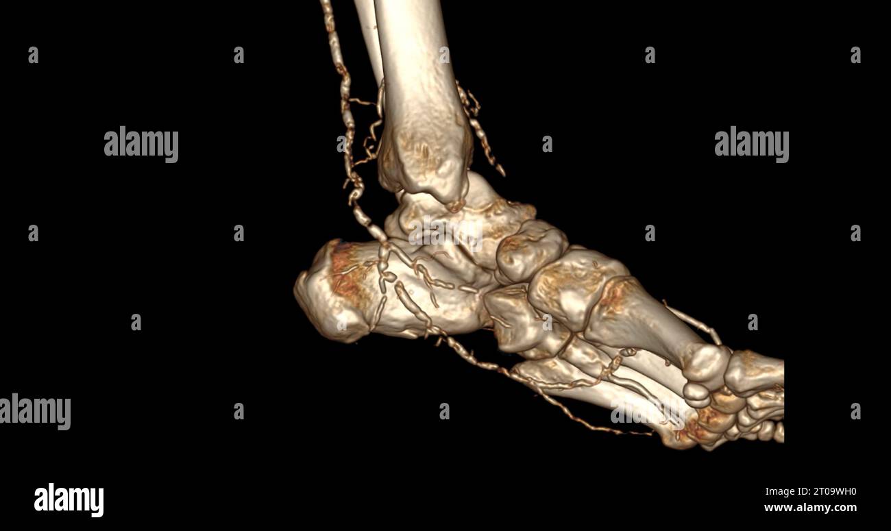 Foot 3D Scan for diagnosis foot diseases by CT-SCANNER Stock Photo - Alamy
