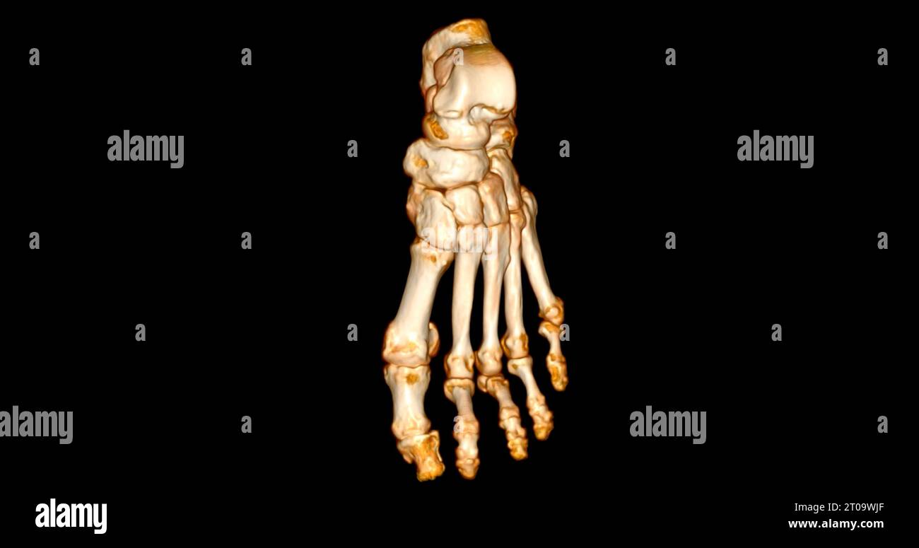 Foot 3D Scan for diagnosis foot diseases by CT-SCANNER Stock Photo - Alamy